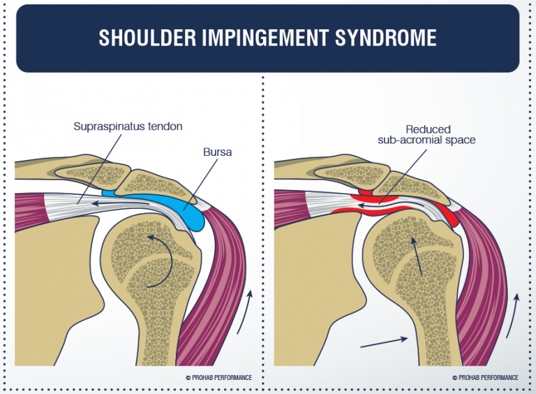 Shoulder Pain: Forward Shoulder Posture
